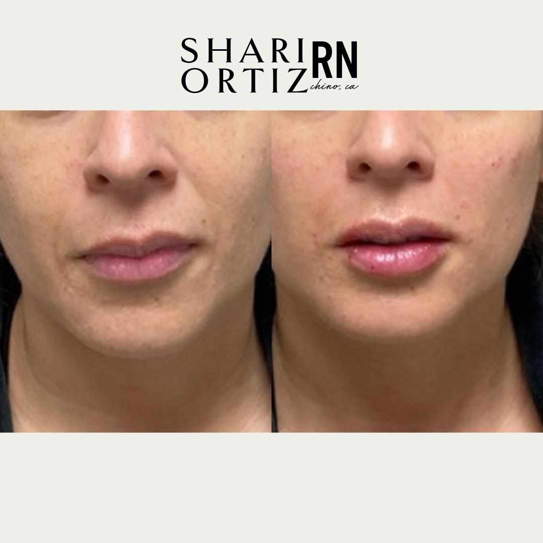 Botox & Fillers Services Chino, CA - Bronzed Beauty Bar